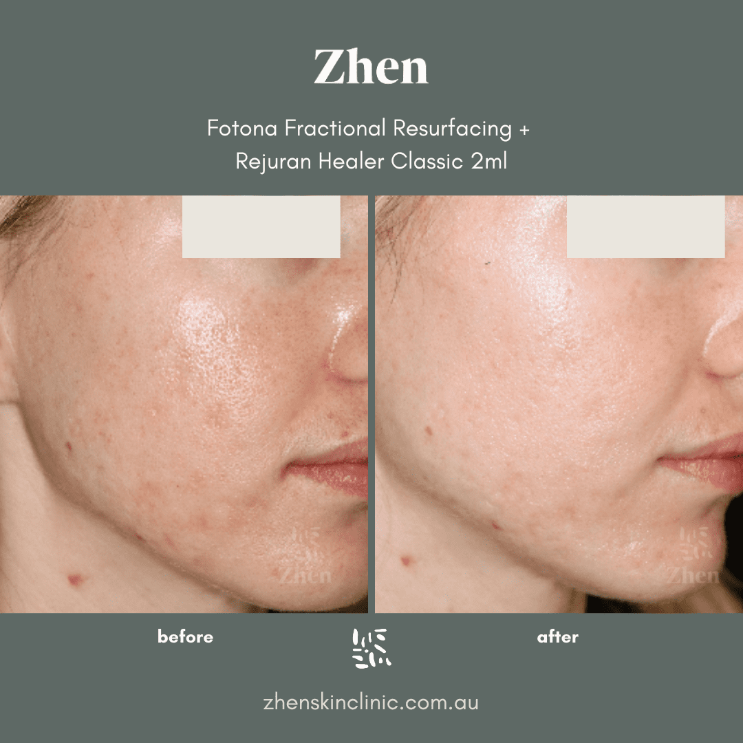 Fotona Fractional Laser Resurfacing | Zhen Skin Clinic