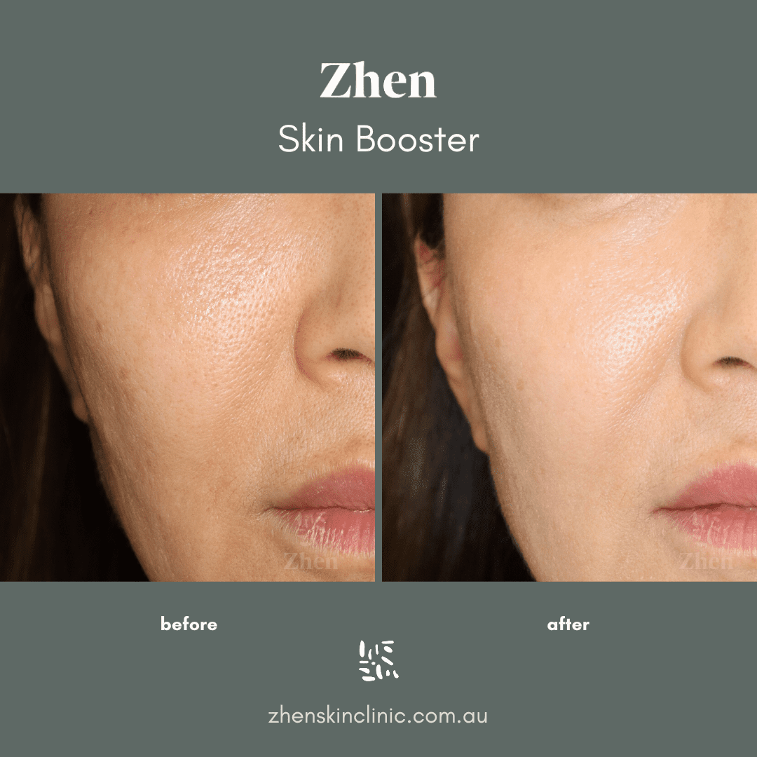 Skin Booster – Zhen Skin Clinic