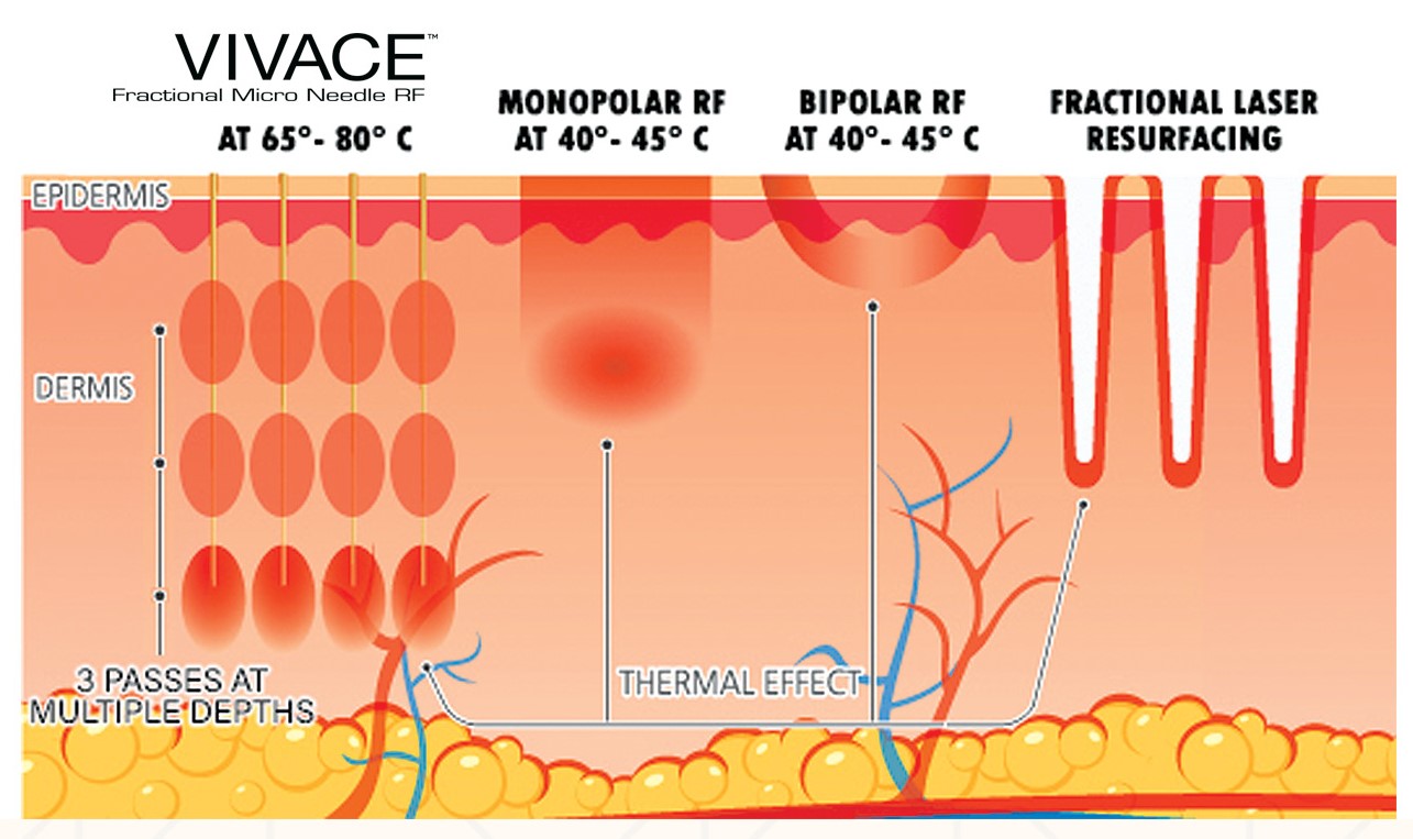 Vivace RF Microneedling Treatment | Zhen Skin Clinic